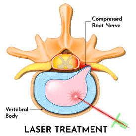 Laser Surgery for the Back - How Does It Work? | AllSpine