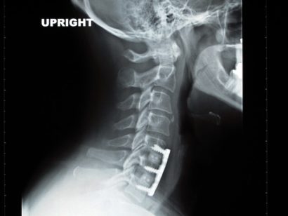 Anterior Cervical Discectomy & Fusion | AllSpine Laser & Surgery Center