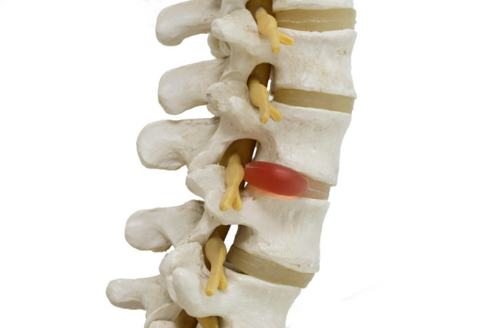 Herniated Disc Treatment and Symptoms | AllSpine