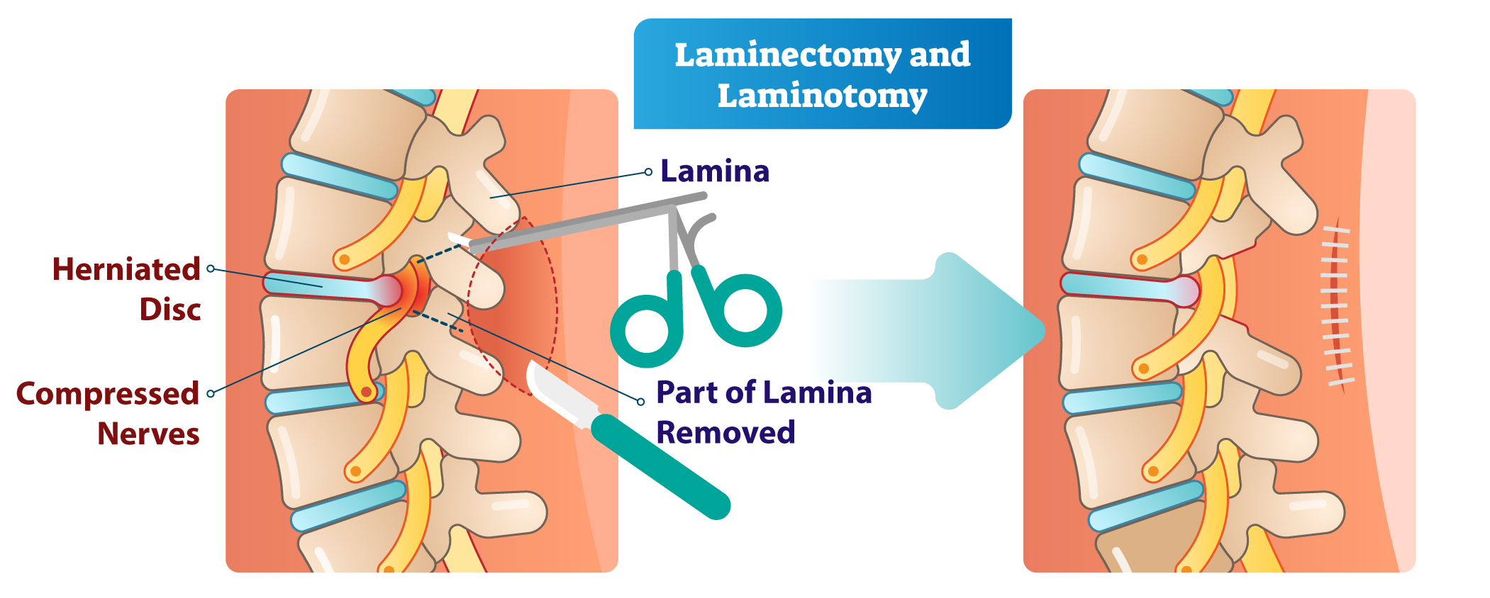 How Long Does A Lumbar Laminectomy Take At Richard Randolph Blog