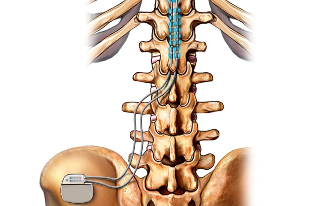Spinal Cord Stimulator Battery Replacement