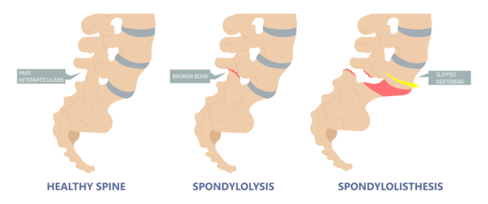 Cervical & Lumbar Spondylosis Pain and Treatment | AllSpine