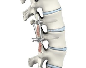 Spondylolisthesis Pain, Treatment & Surgery | AllSpine