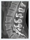 Myelogram Imaging Test | AllSpine