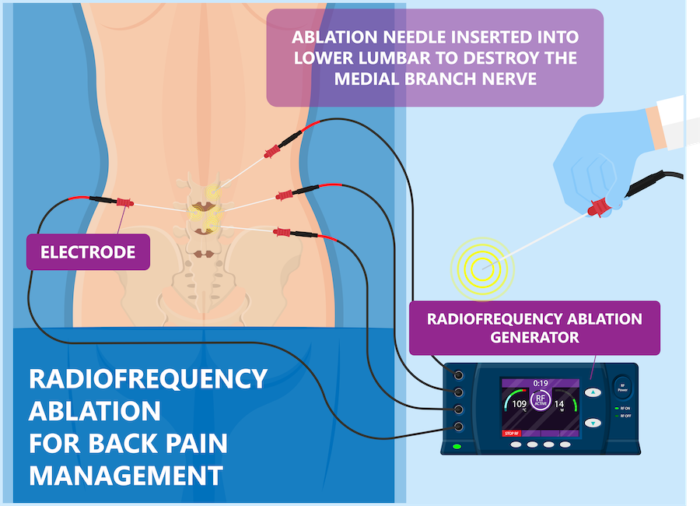 Radiofrequency Ablation AllSpine Laser Surgery Centers Radiofrequency Ablation AllSpine Laser Surgery Centers