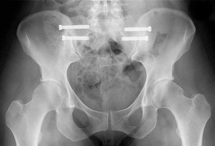 Sacroiliac Joint Pain | AllSpine Laser & Surgery Centers GA