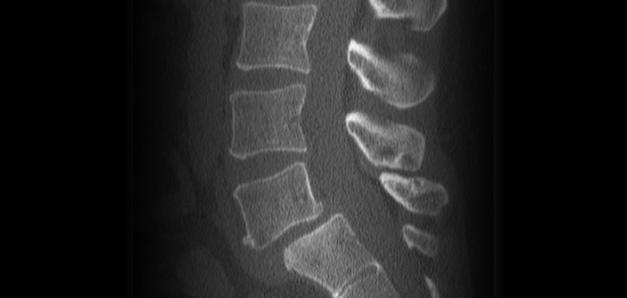 Spondylolisthesis Pain, Treatment & Surgery | AllSpine