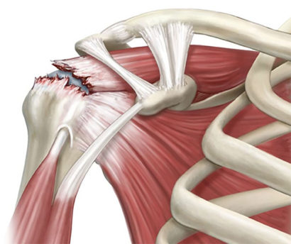 Torn Rotator Cuff Injury Symptoms & Treatment | AllSpine