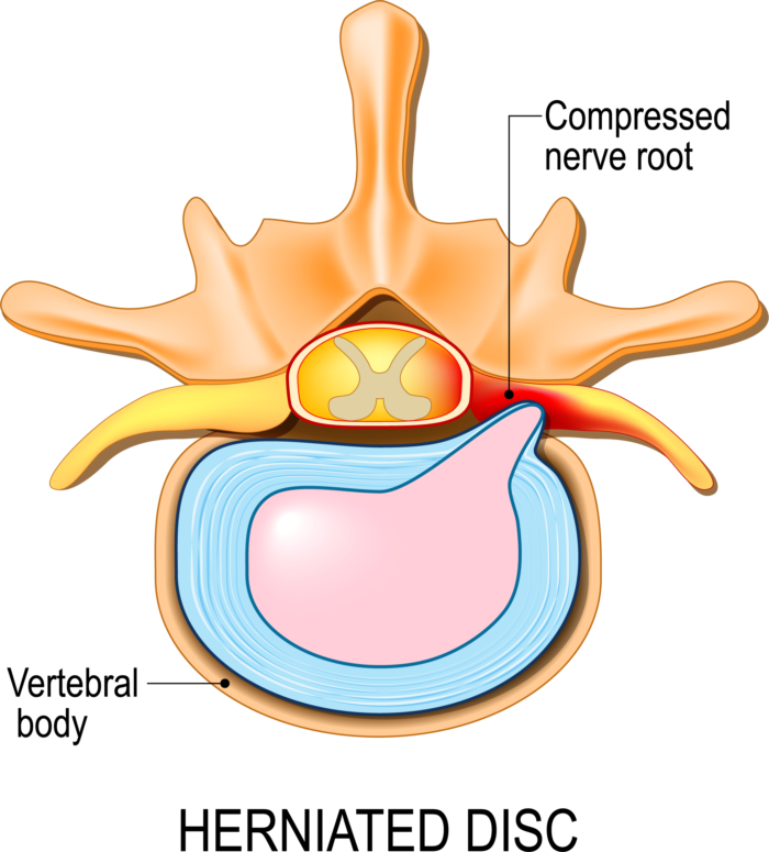How Long Does a Pinched Nerve Last? | AllSpine
