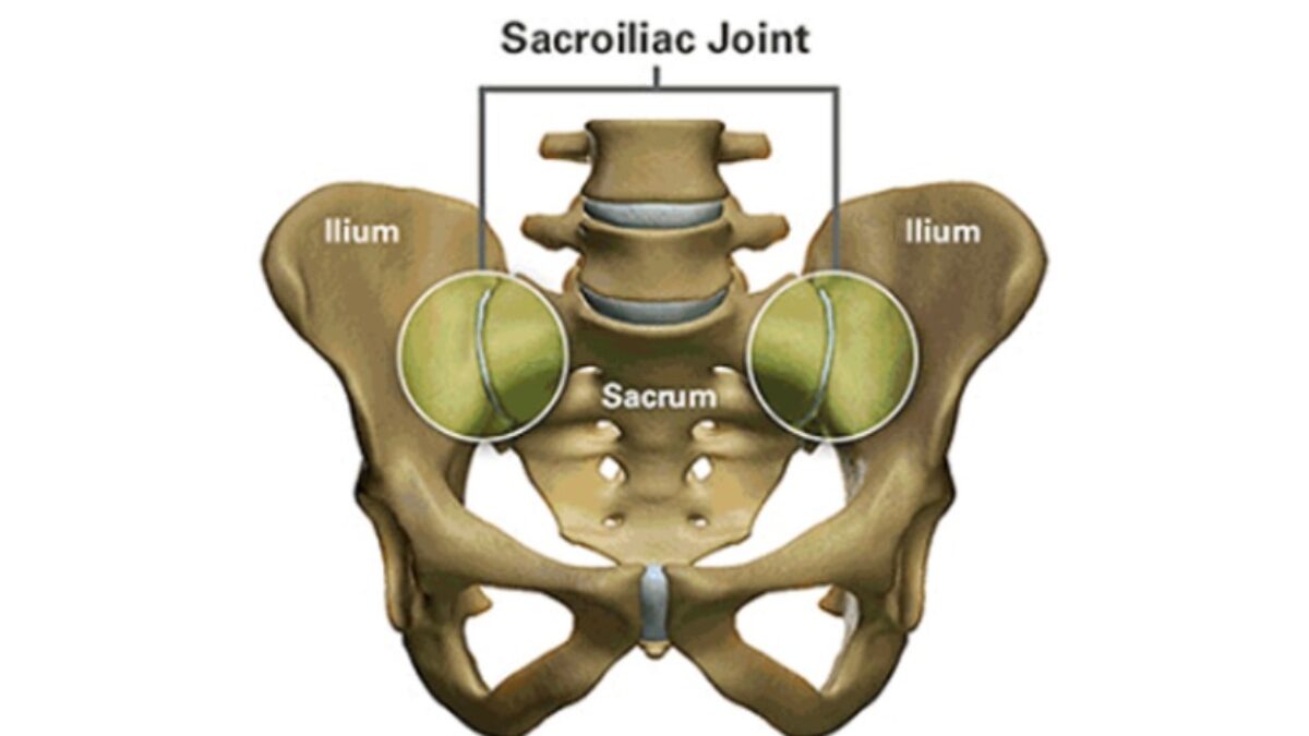 Sacroiliac Fusion Sacroiliac Joint Pain Helena | Spine Deformities